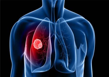 Câncer de pulmão: novo remédio dobra sobrevida | Só Notícia Boa