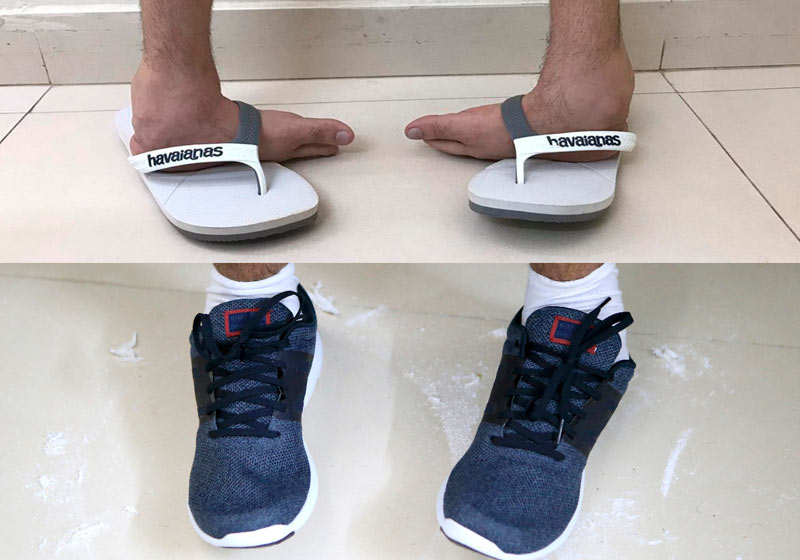 Tratamento inédito corrige pé torto congênito de adulto sem cirurgia ...