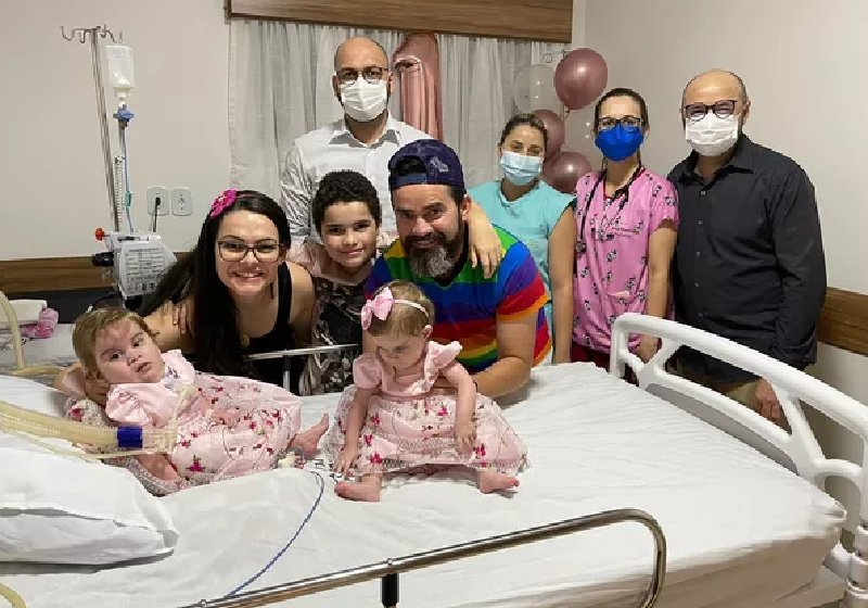 Gêmeas siamesas separadas em SP passam bem. Cirurgia teve ajuda de ...