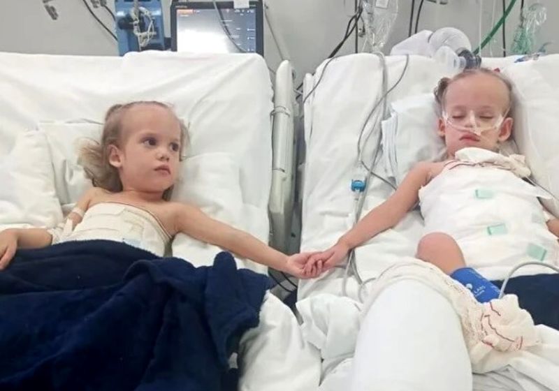 Gêmeas siamesas recebem alta da UTI 35 dias após separação | Só Notícia Boa